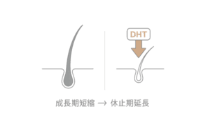 ジヒドロテストステロンのメリットと筋トレの影響 | 薄毛（AGA）の原因・検査ならAGAメディカルケアクリニック
