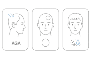 はげ方のパターンと種類からわかる治療方針 | 薄毛（AGA）の原因・検査ならAGAメディカルケアクリニック